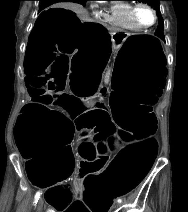EDIC - Toxic Megacolon – edicexam.com